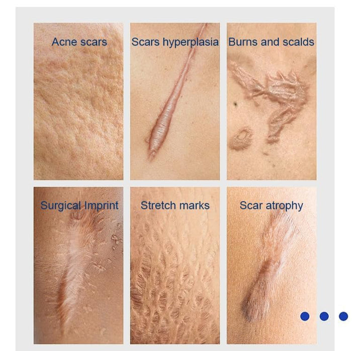 Scar Removal Cream – Advanced Repair for Flawless Skin! – Vital Smyle
