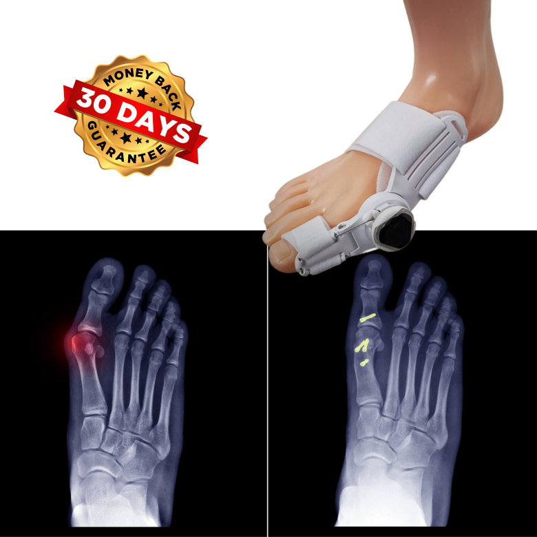 ToeAlign™ Mechanical Bunion Corrector Brace – Vital Smyle